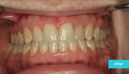 Invisalign London - £1000 off Clear Braces | Invisalign Offers